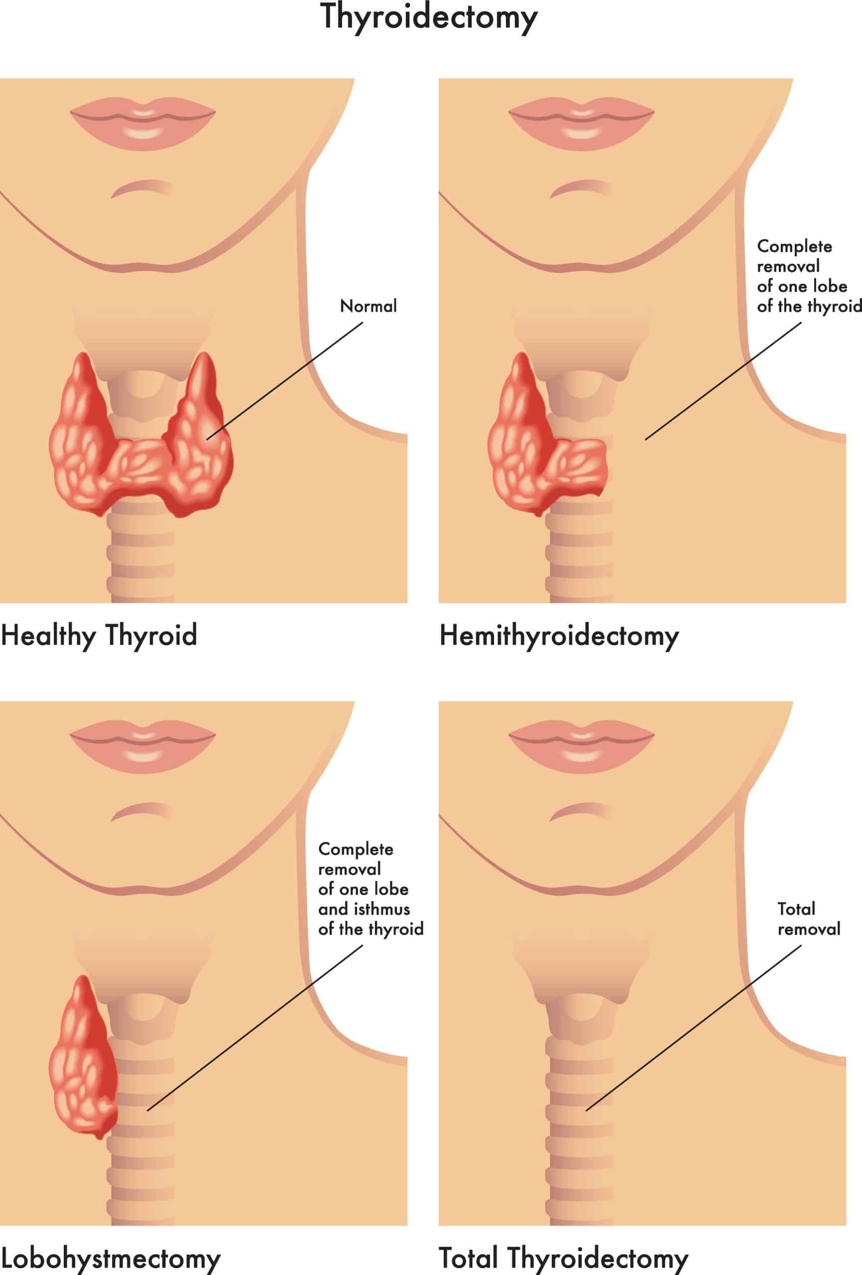 Thyroid Gland and Thyroidectomy: Functions and CPT Codes